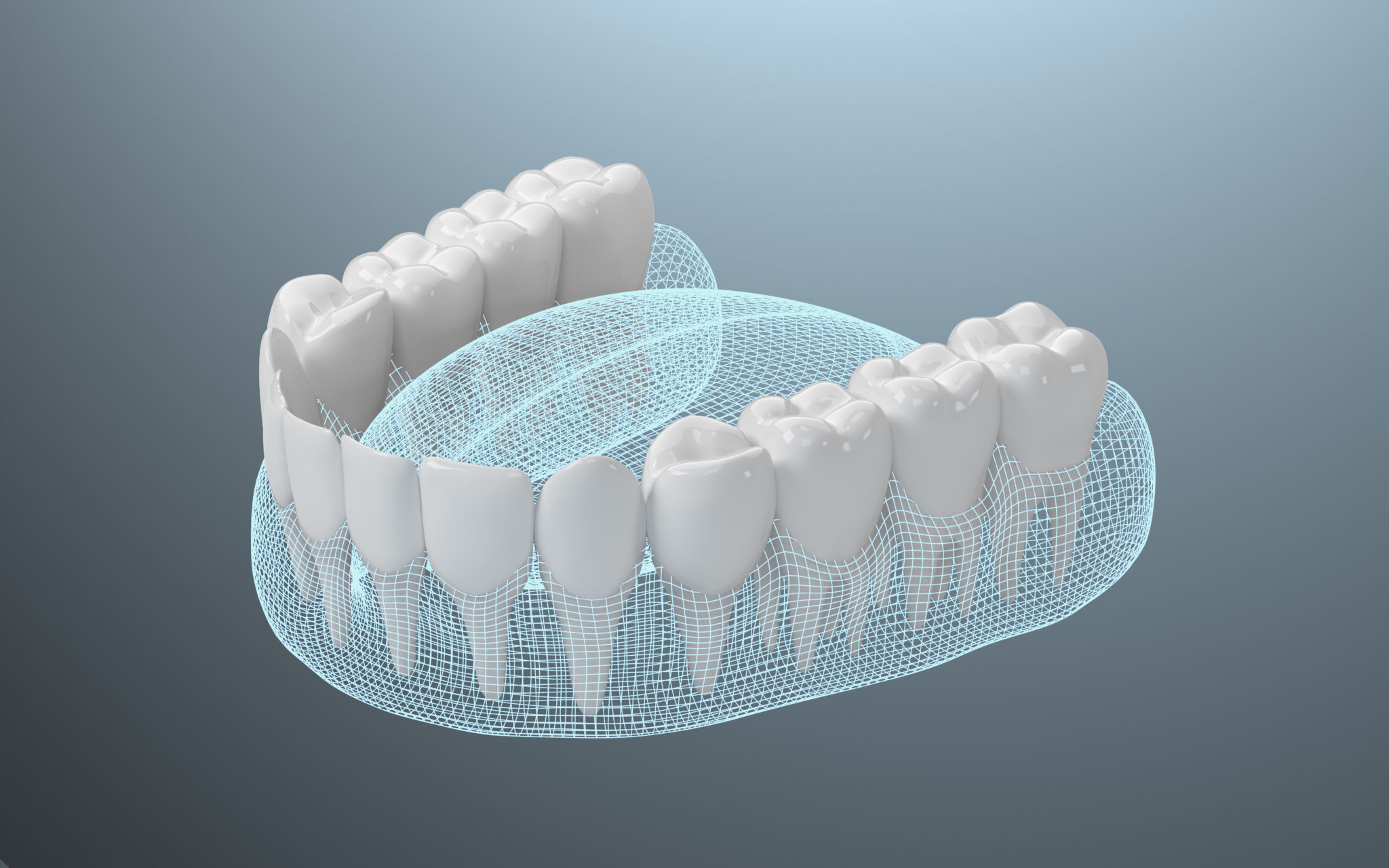 A Closer Look at CAD/CAM Technology in Digital Dentures | Ottawa South ...